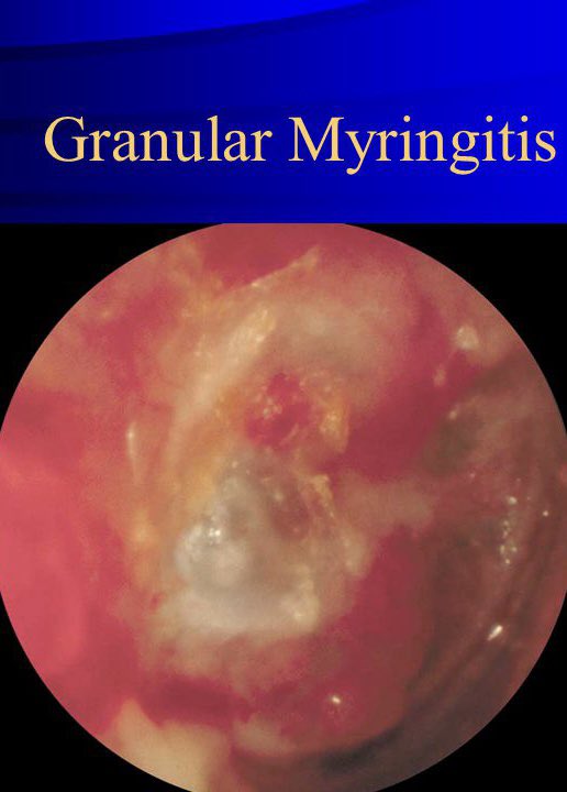 Granular Myringitis