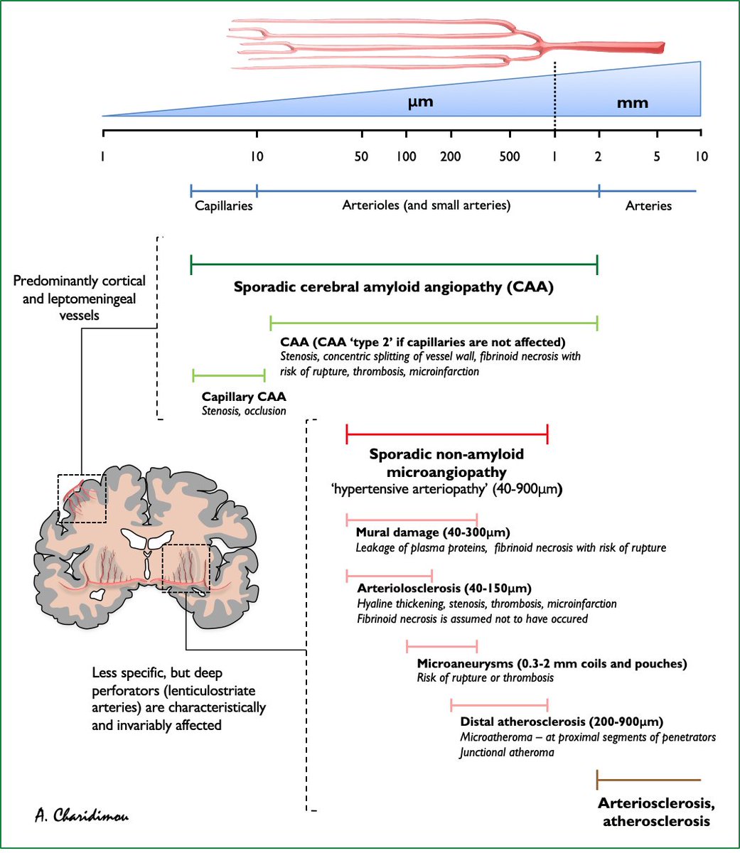 🤿🧠 Cerebral Amyloid Angiopathy (CAA) - A 'Twitter' Review 1) What is ...