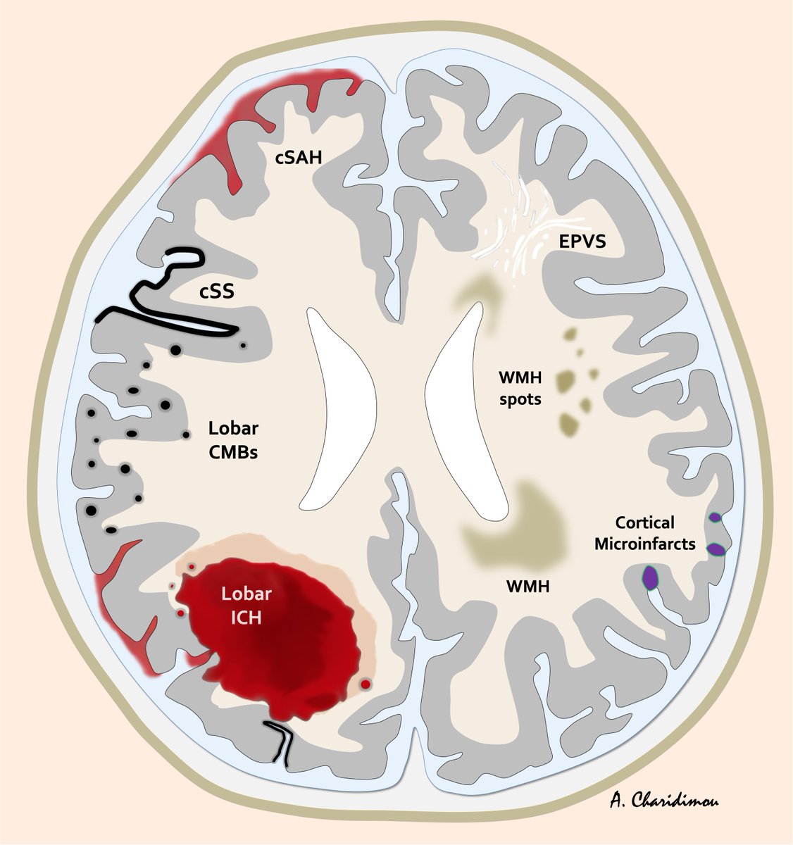 🤿🧠 Cerebral Amyloid Angiopathy (CAA) - A 'Twitter' Review 1) What is ...