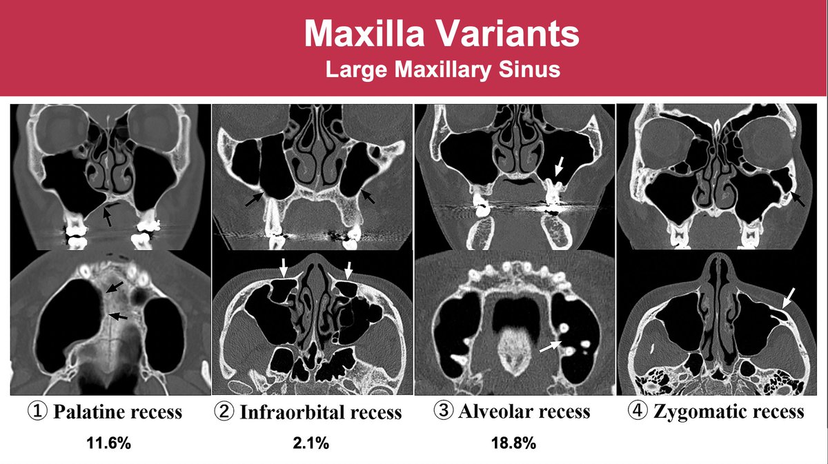 Welcome to my first #Tweetorial on the imaging of normal variants in ...