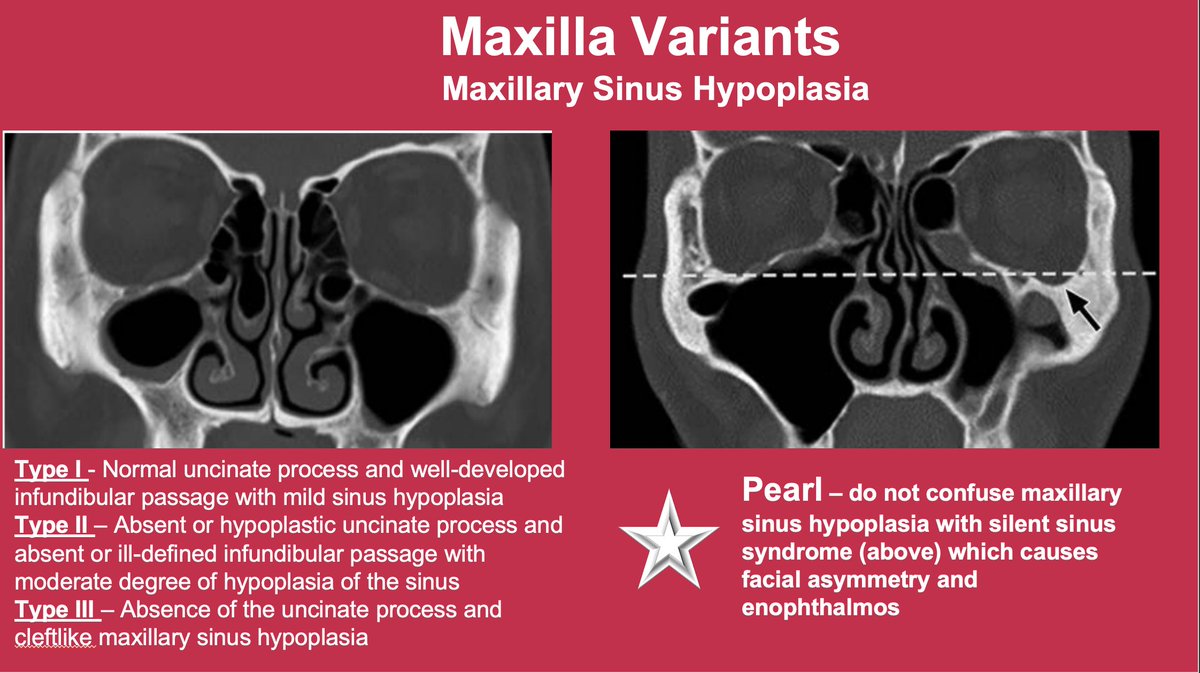 Welcome to my first #Tweetorial on the imaging of normal variants in ...