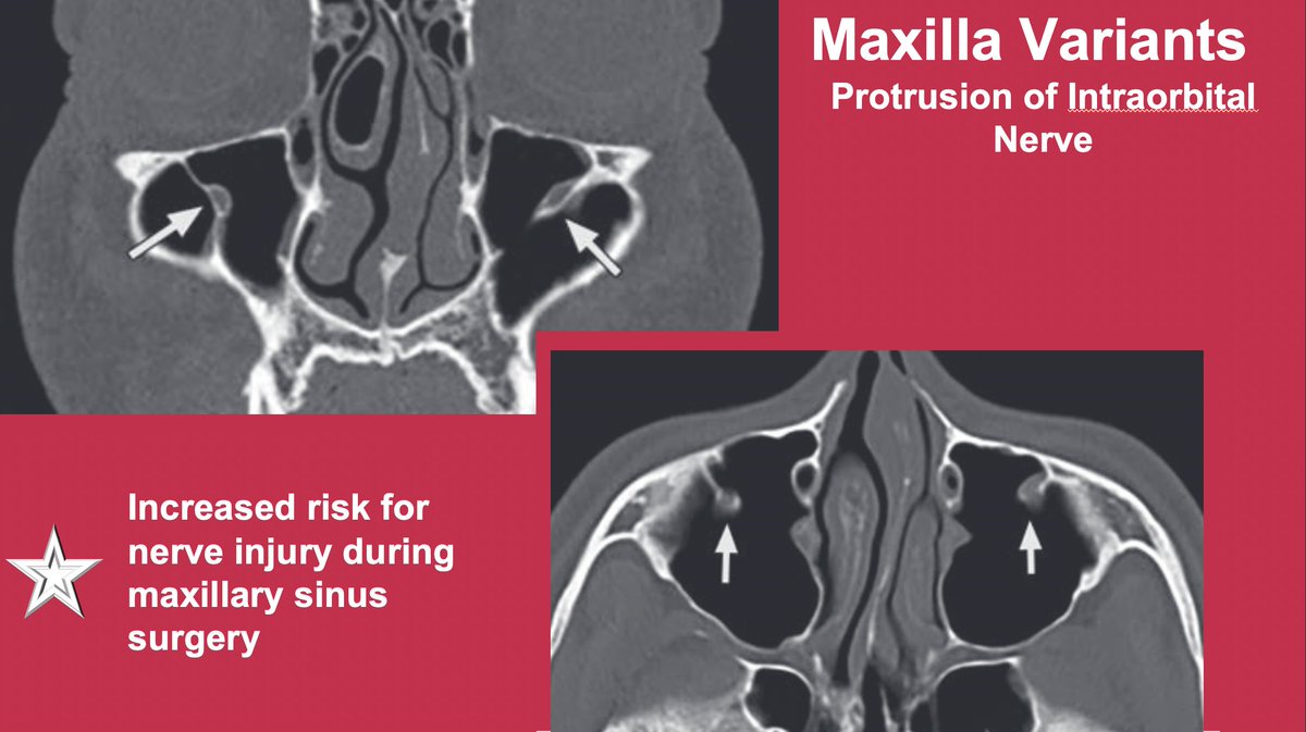 Welcome to my first #Tweetorial on the imaging of normal variants in ...