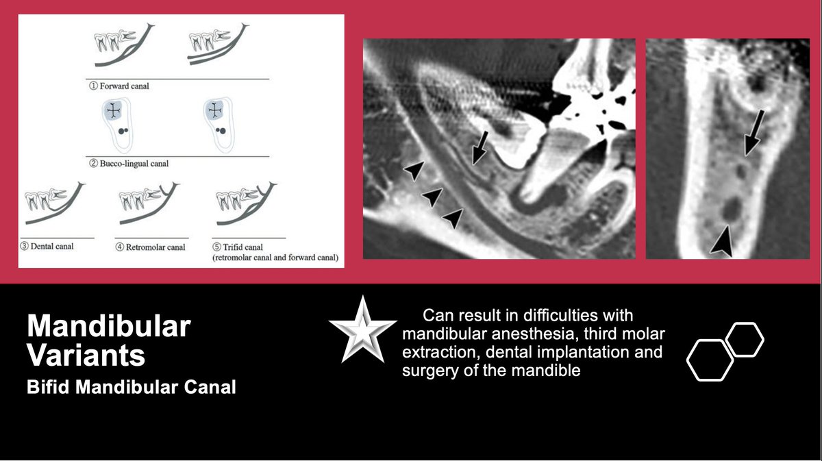 Welcome to my first #Tweetorial on the imaging of normal variants in ...
