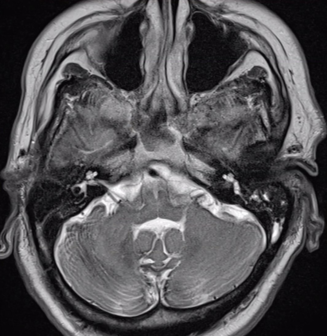Mastoid Air Cells Mri
