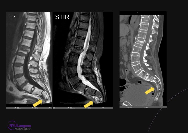 Sacral Area Edema