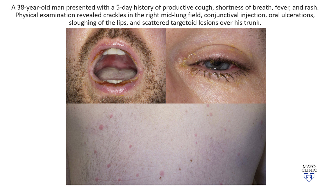 Images of Infectious Diseases An immunocompetent man presents with # ...