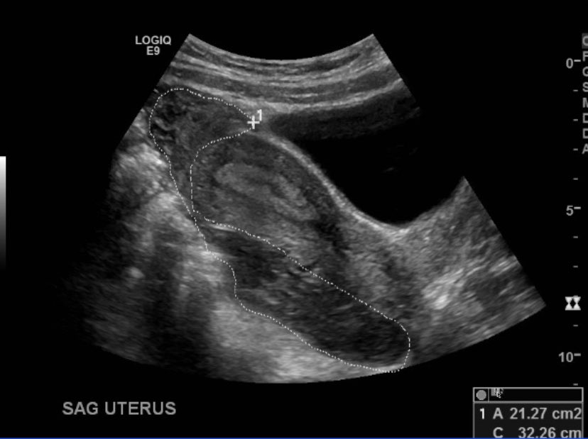 Ovarian Cyst Transabdominal Ultrasound