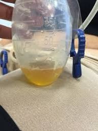 Serosanguinous Drainage