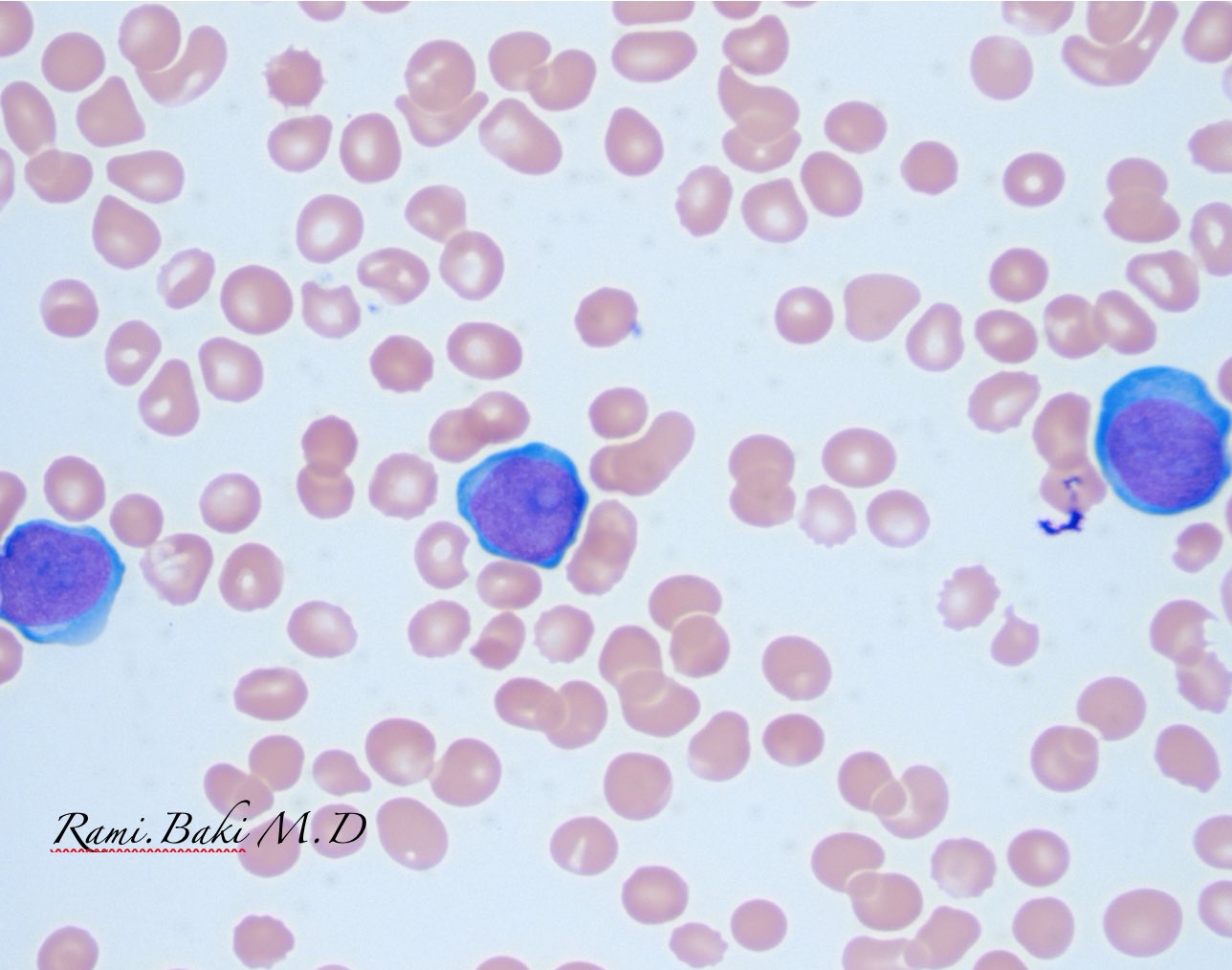 Blast Peripheral Blood