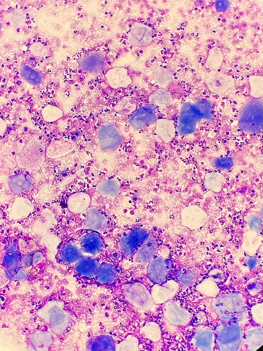 Epidermal Inclusion Cyst Cytology
