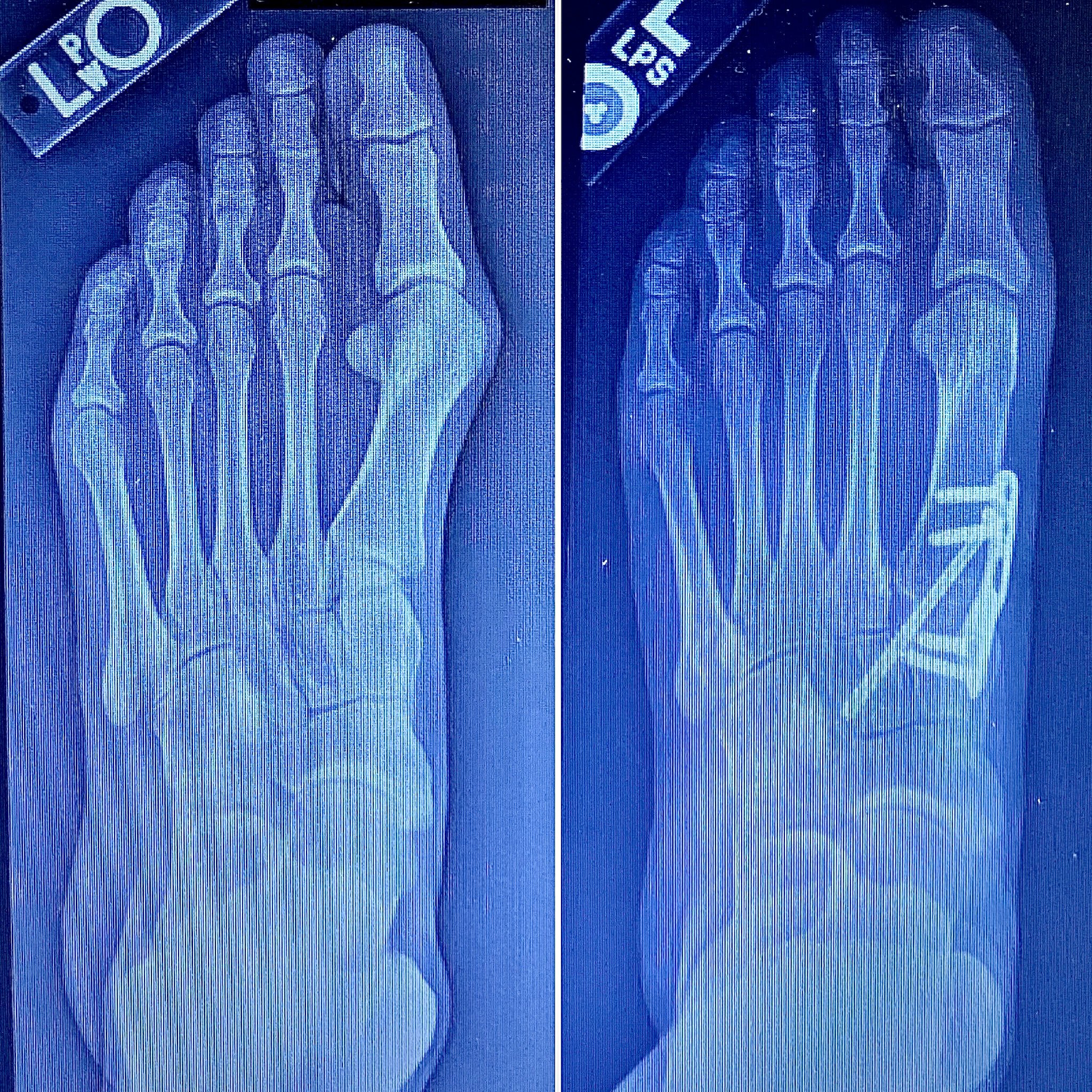 Lapidus Bunionectomy