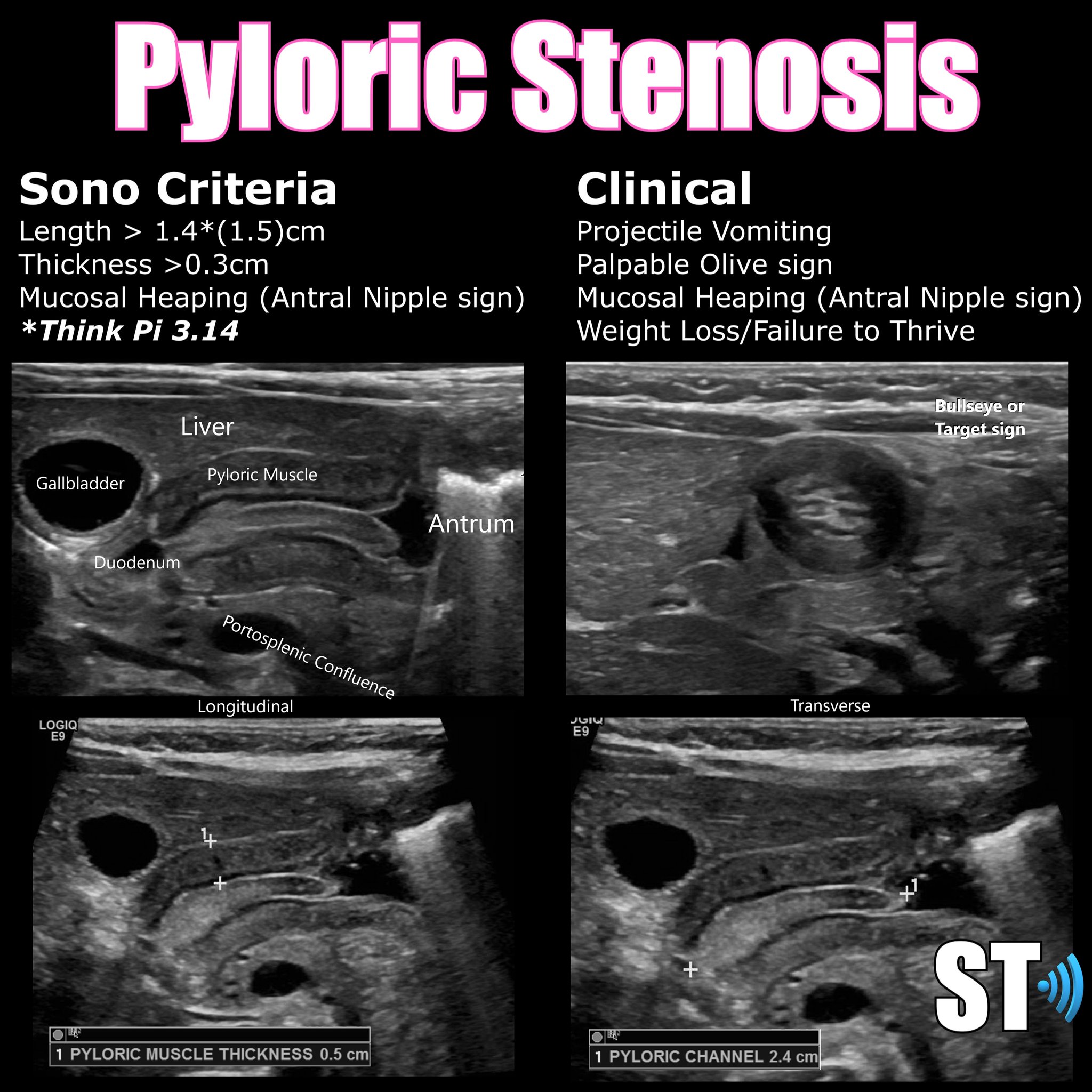 Pyloric Stenosis Ultrasound Measurements