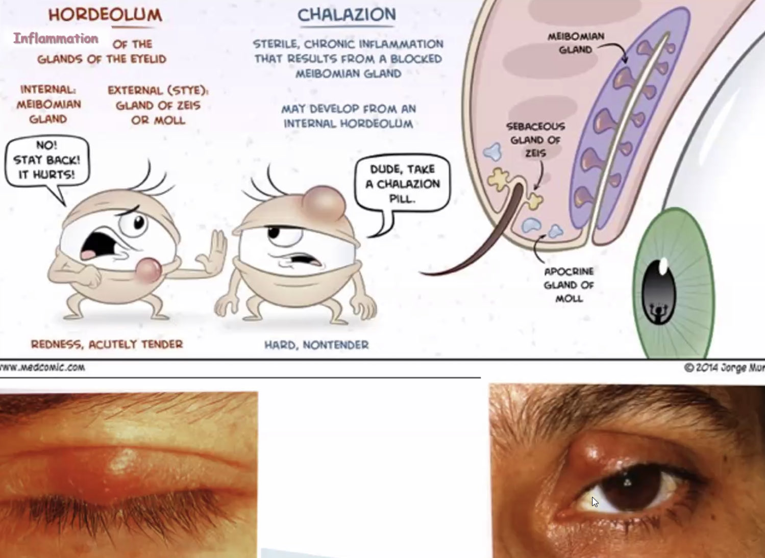 Internal Vs External Hordeolum Internal Vs External Hordeolum