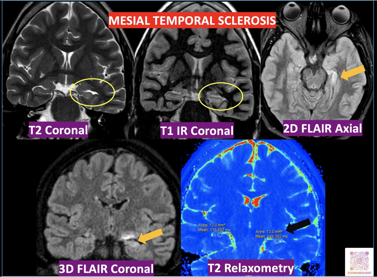 Medial Temporal Lobe Epilepsy