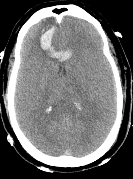 If the Cashew Nut sign should make you worry about venous sinus ...