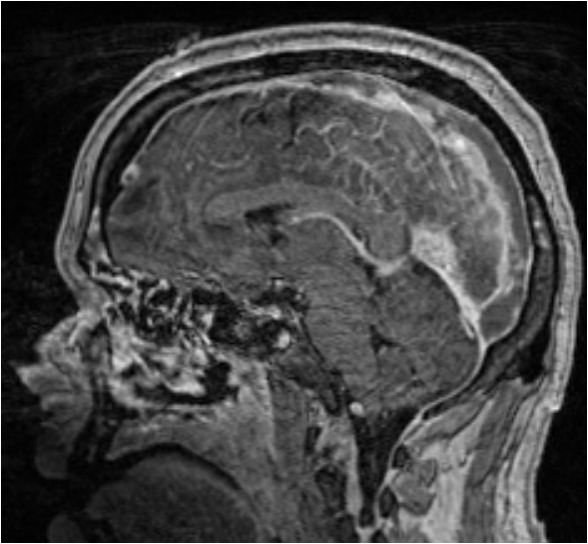 If the Cashew Nut sign should make you worry about venous sinus ...