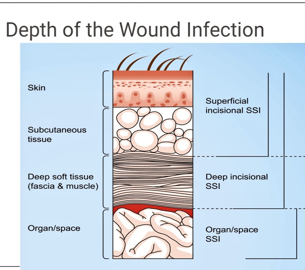 Wound Infection Diagram