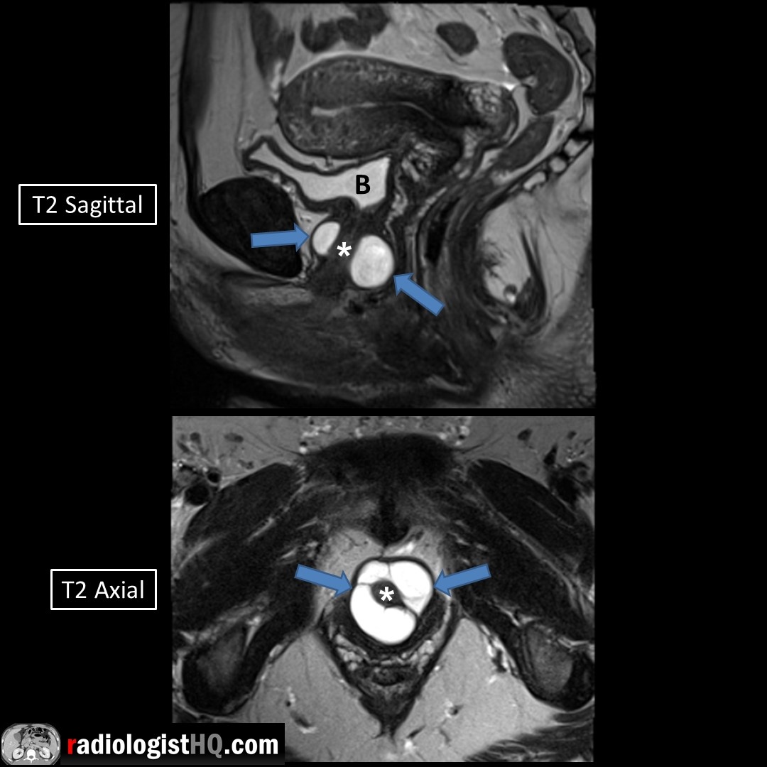 Urethral Diverticulum