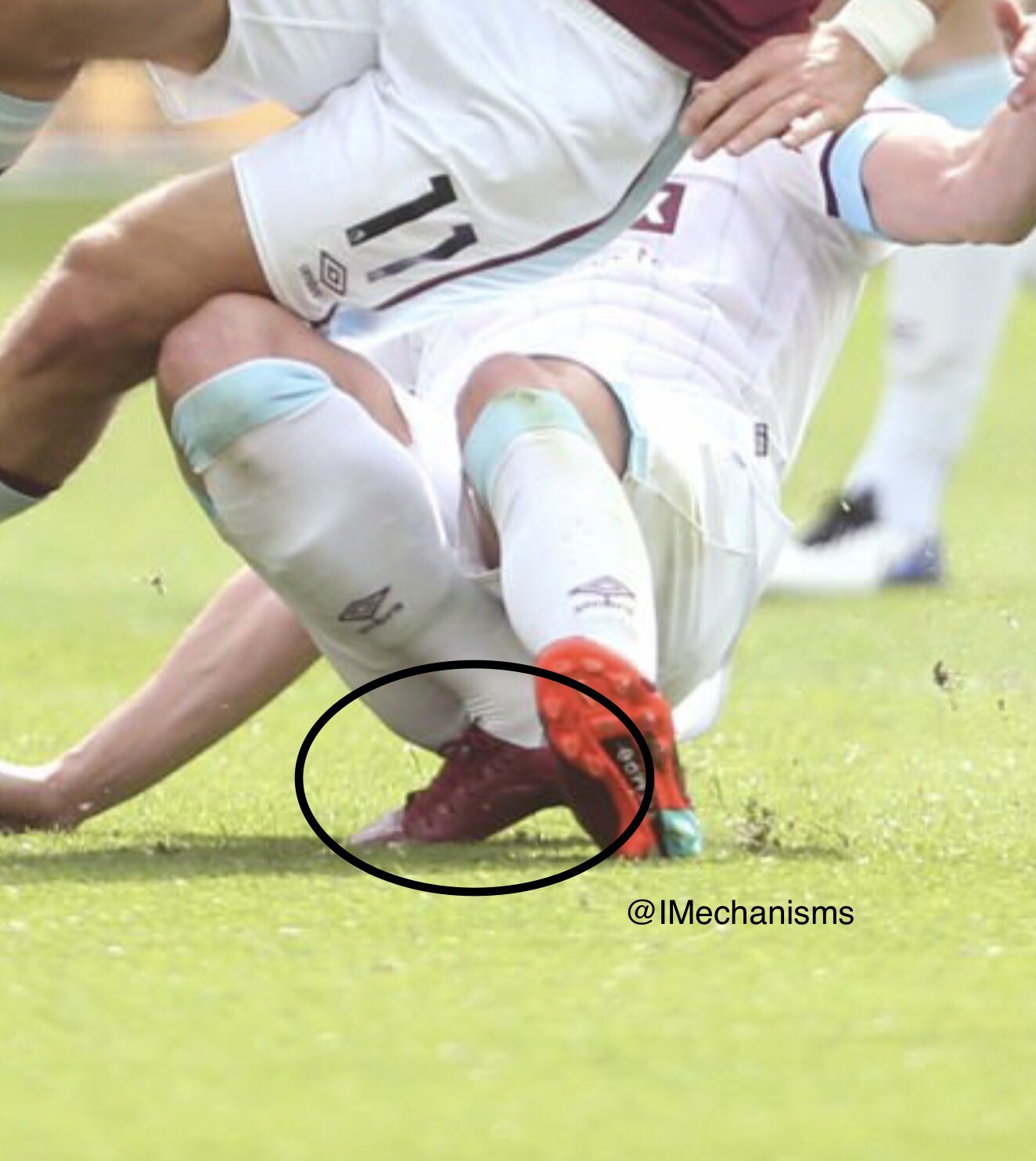 Ankle Dislocation Football