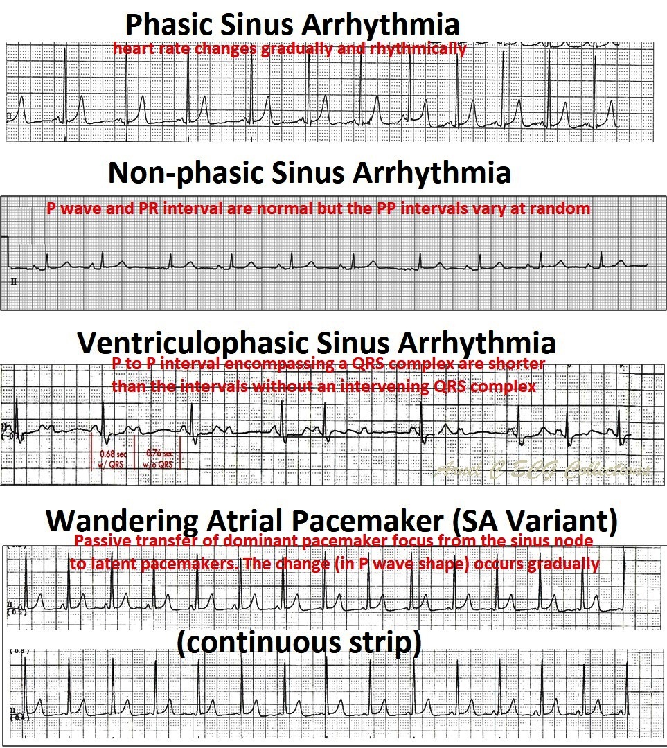 Sinus Arrhythmia