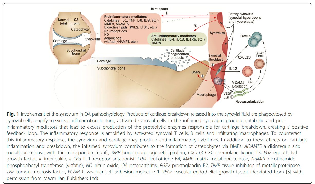 Physio Meets Science on Twitter: "Synovitis in osteoarthritis: Current understanding with ...