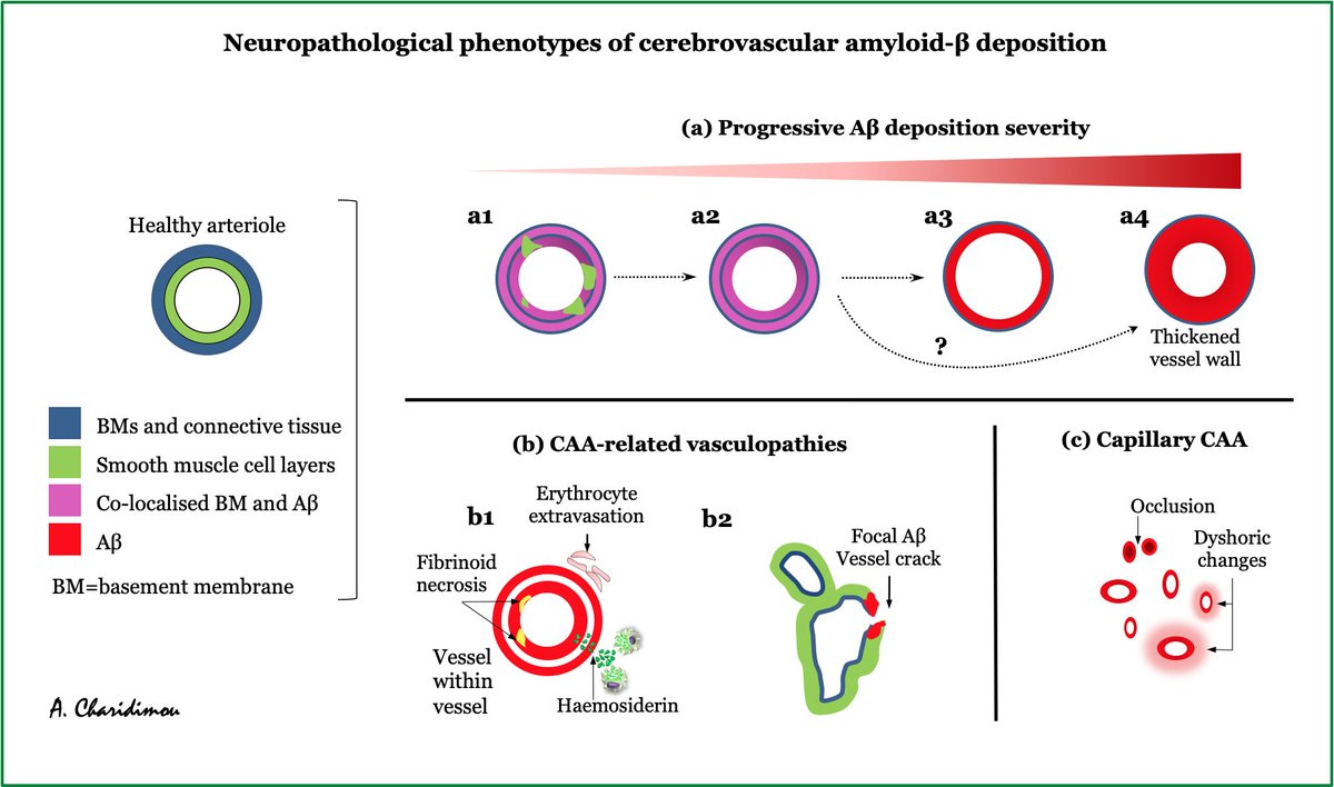 🤿🧠 Cerebral Amyloid Angiopathy (CAA) - A 'Twitter' Review 1) What is ...