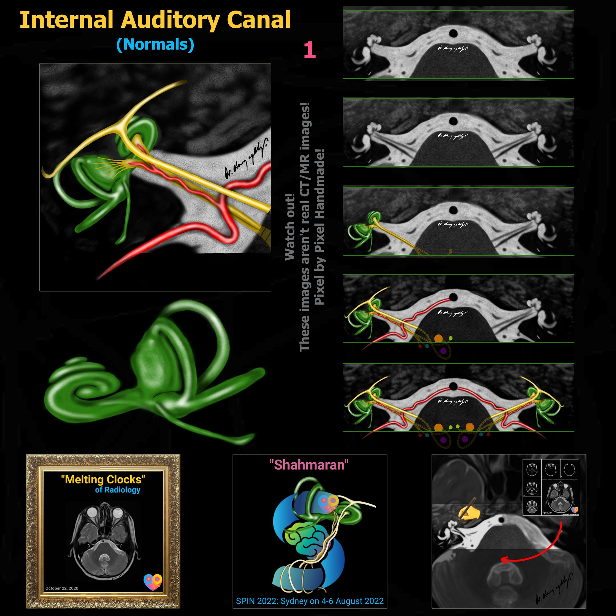 Internal Auditory Canal
