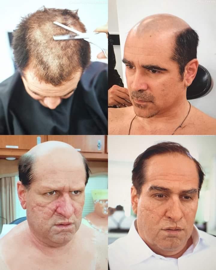 Colin Farrell Hair Loss