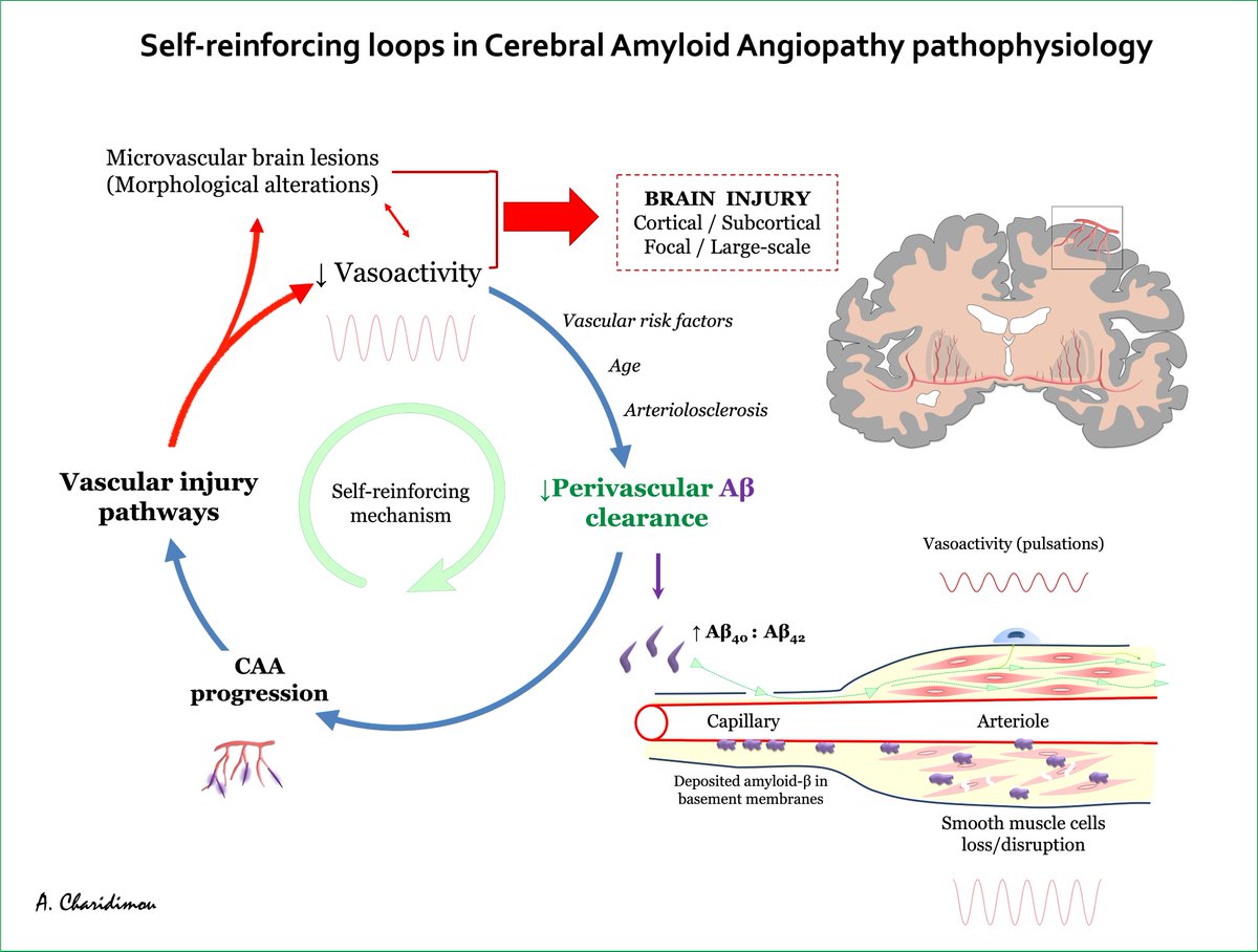 🤿🧠 Cerebral Amyloid Angiopathy (CAA) - A 'Twitter' Review 1) What is ...
