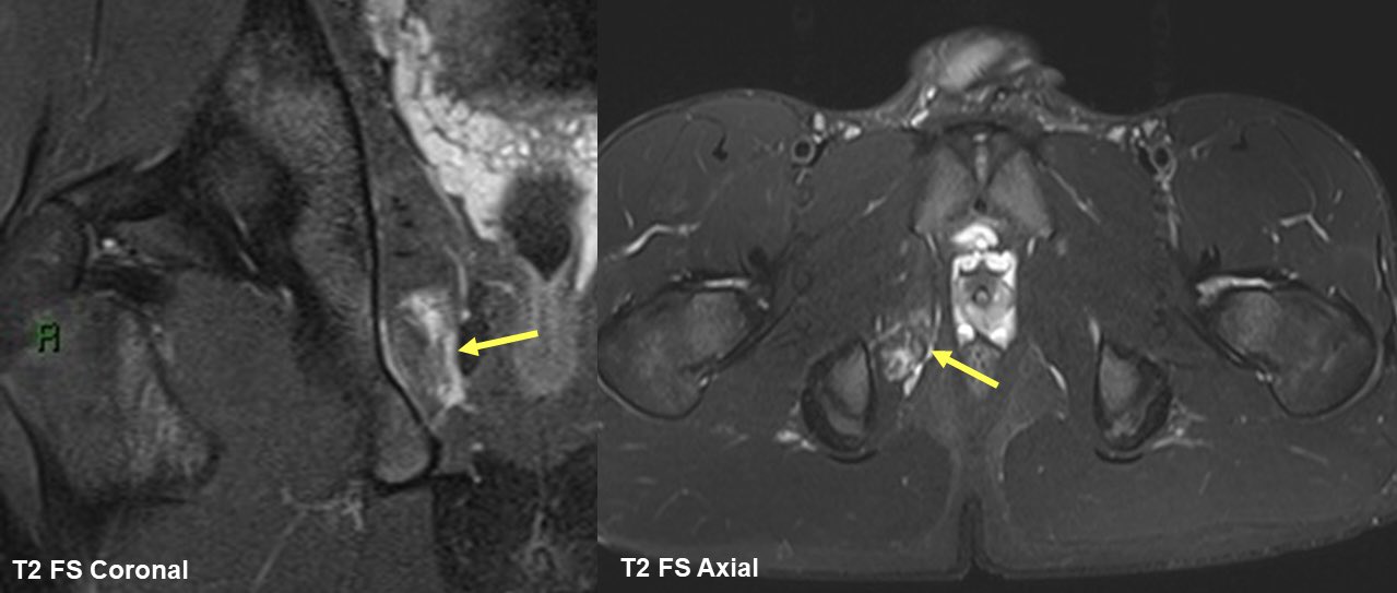 Obturator Internus Mri