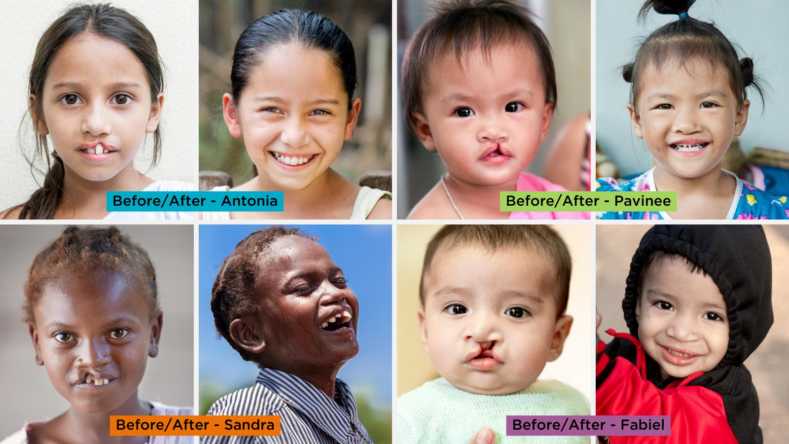 Operation Smile Before And After