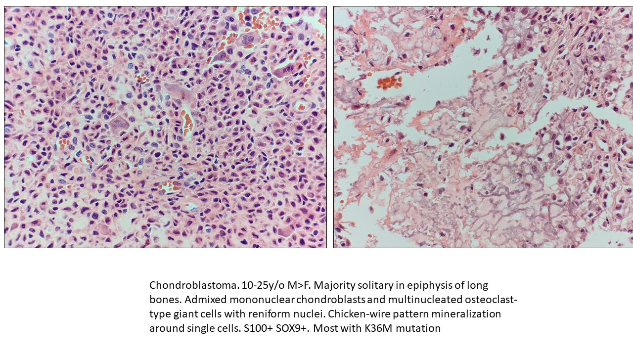 Chondroblastoma Pathology Outlines