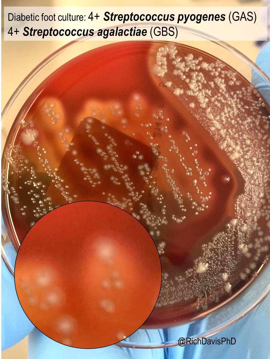 Blood Agar Streptococcus Pyogenes