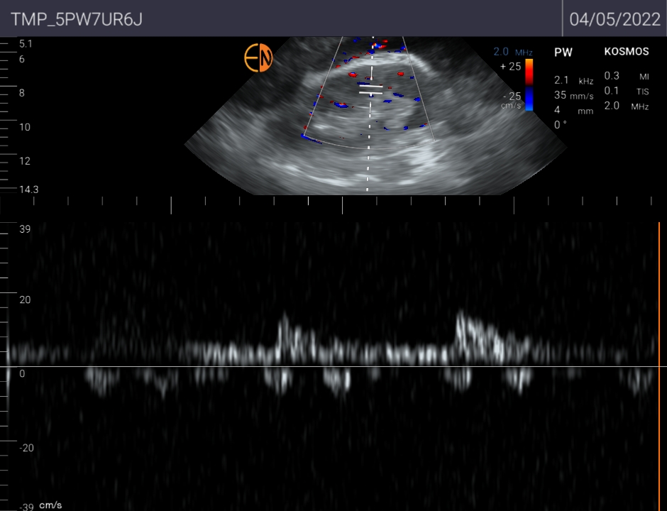 #VExUS Quiz: This is an hepatic vein doppler from a patient presenting ...