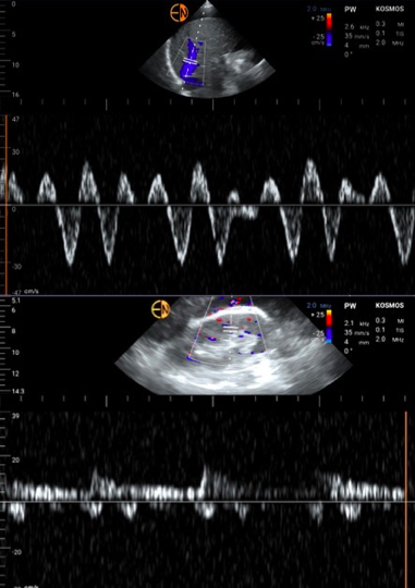 #VExUS Quiz: This is an hepatic vein doppler from a patient presenting ...