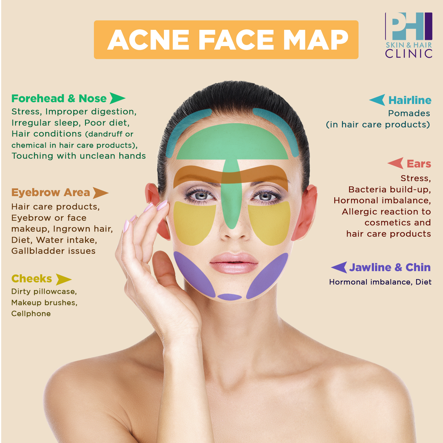Acne Diagram Of The Face