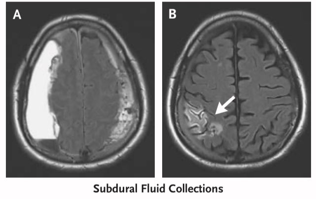 VR-POD8: Spontaneous Intracranial hypotension @NEJM - Thread from ...