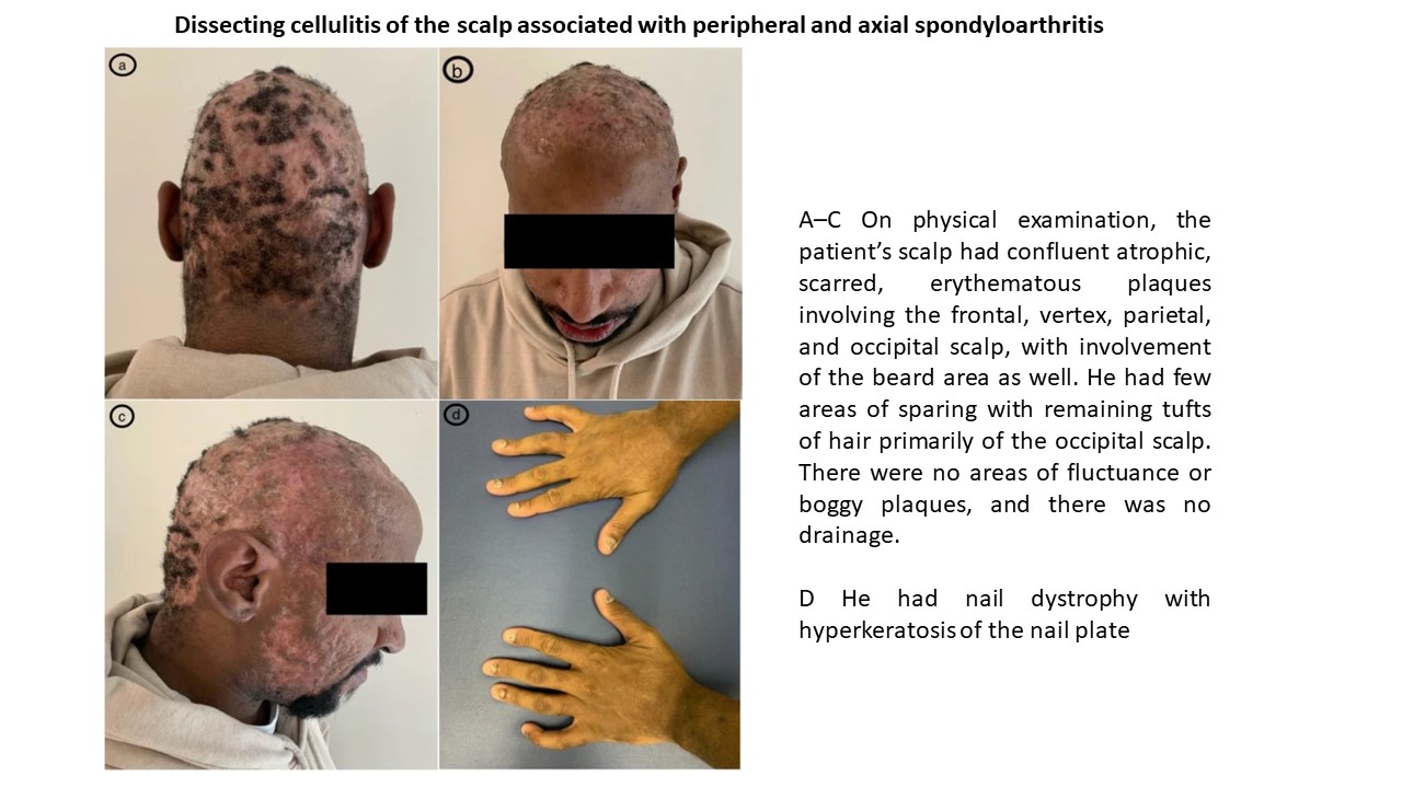 Dissecting Cellulitis