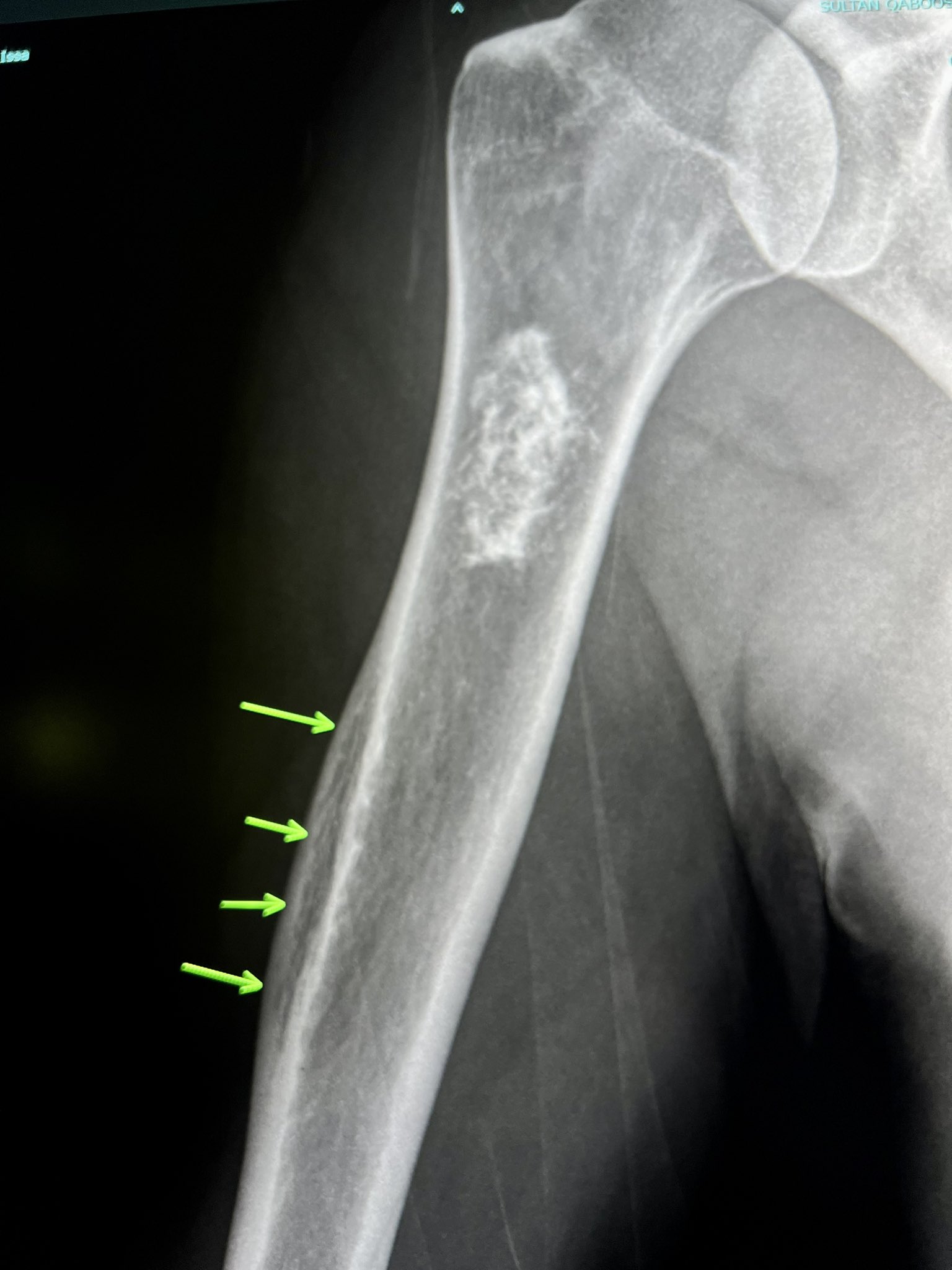 Enchondroma Humerus