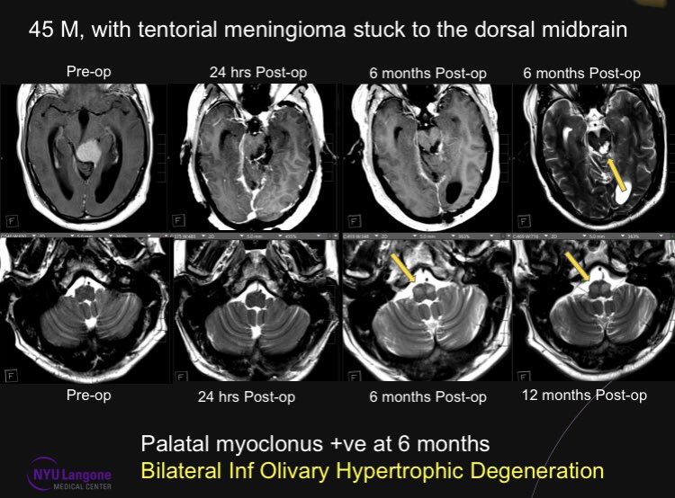 Bilateral Hypertrophy