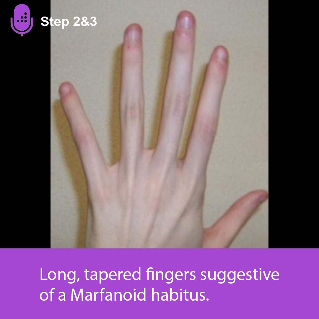 Marfanoid Habitus