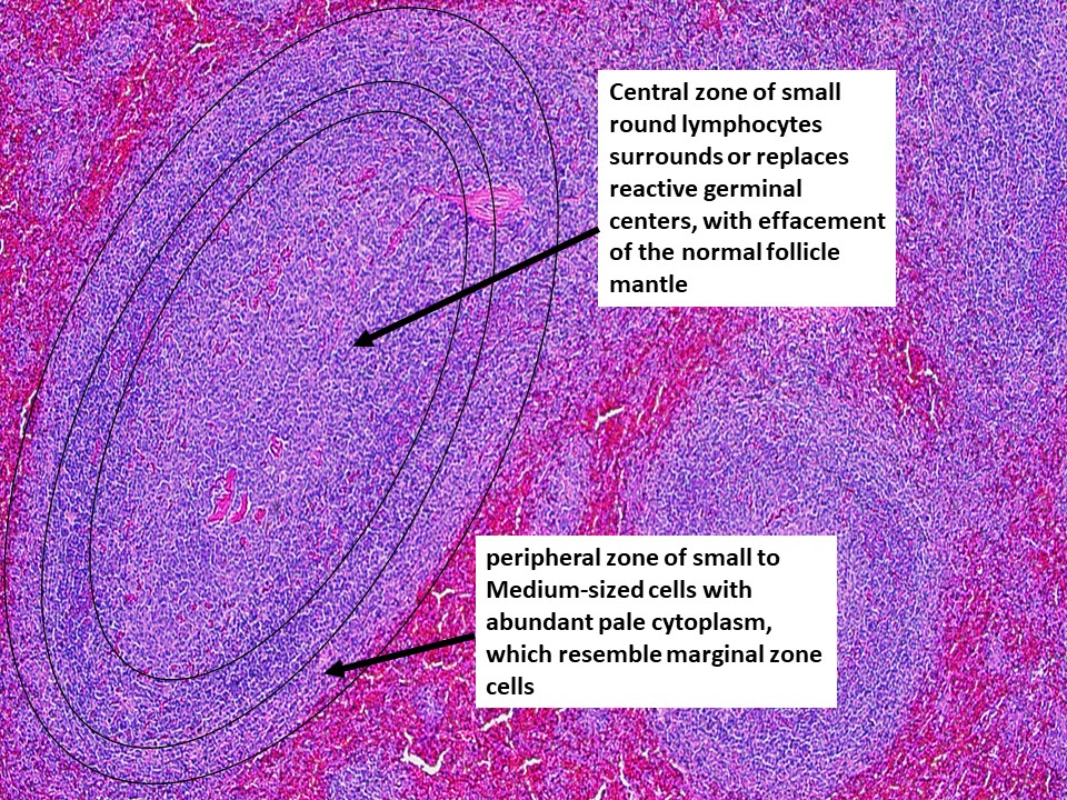 Splenic Marginal Zone Lymphoma