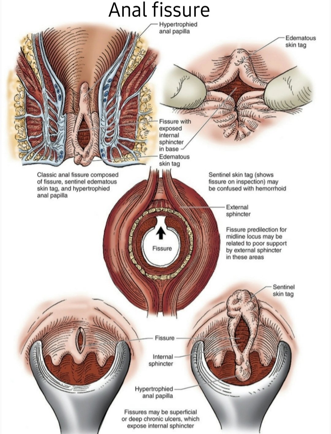 Female Anal Fissure