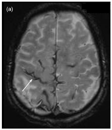 ⚡️🪄Time for an Amyloid Spells #tweetorial Cerebral Amyloid Angiopathy ...