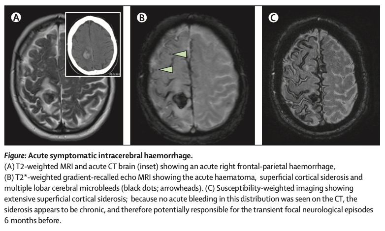 ⚡️🪄Time for an Amyloid Spells #tweetorial Cerebral Amyloid Angiopathy ...