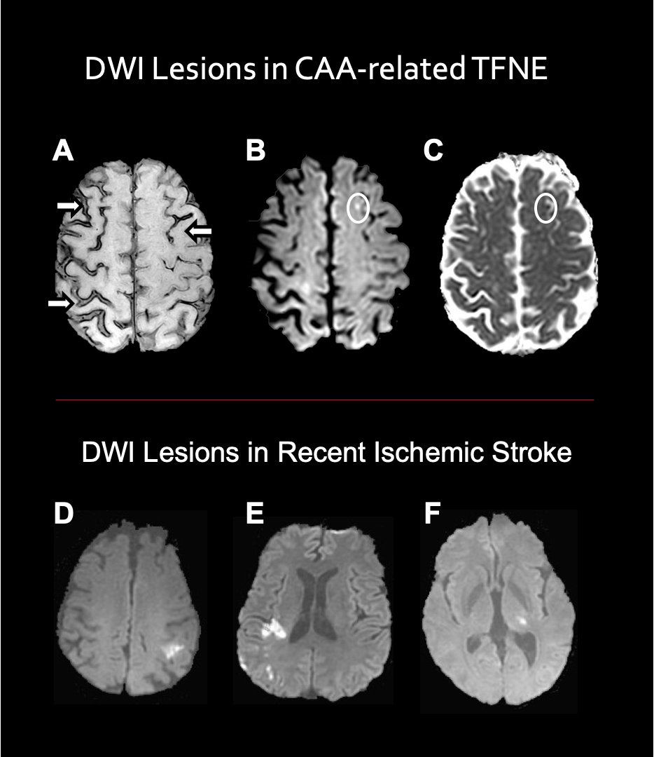 ⚡️🪄Time for an Amyloid Spells #tweetorial Cerebral Amyloid Angiopathy ...