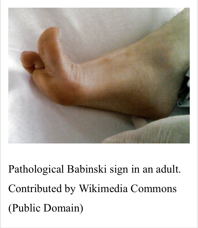 Babinski Sign