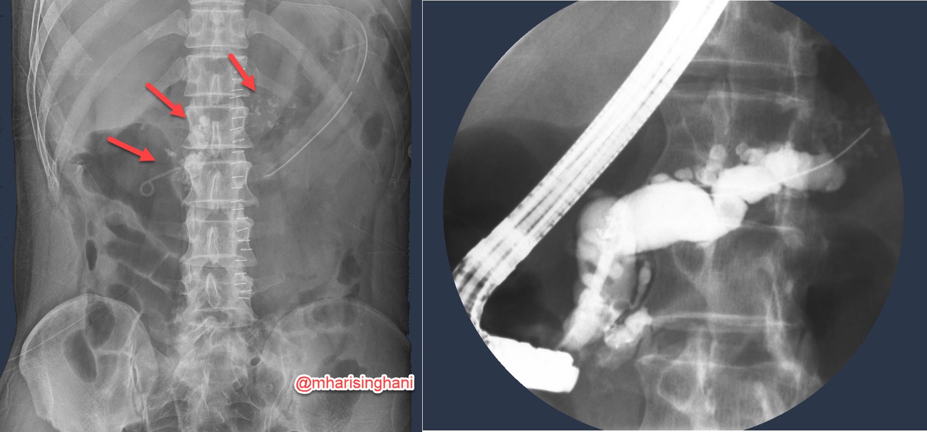 Chronic Pancreatitis Ercp Update On Endoscopic Management Of Main