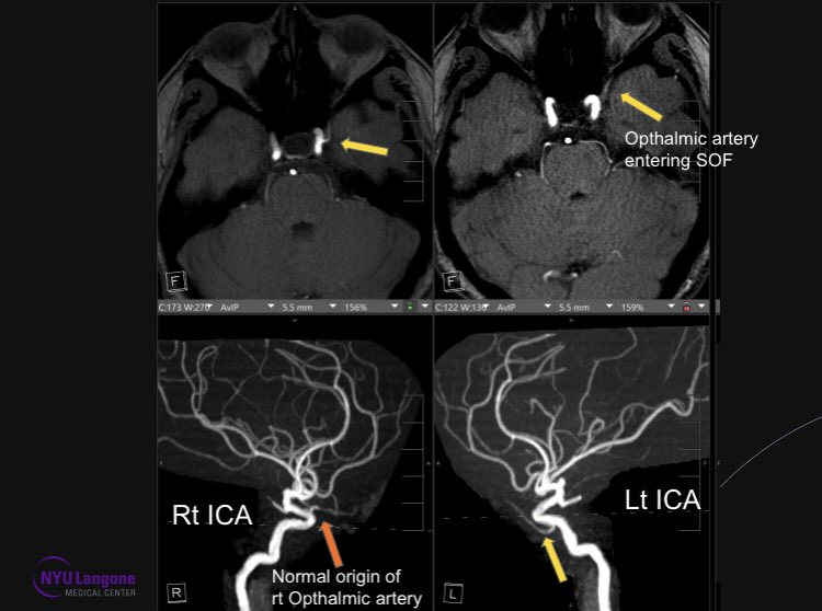 Ophthalmic Artery Mri