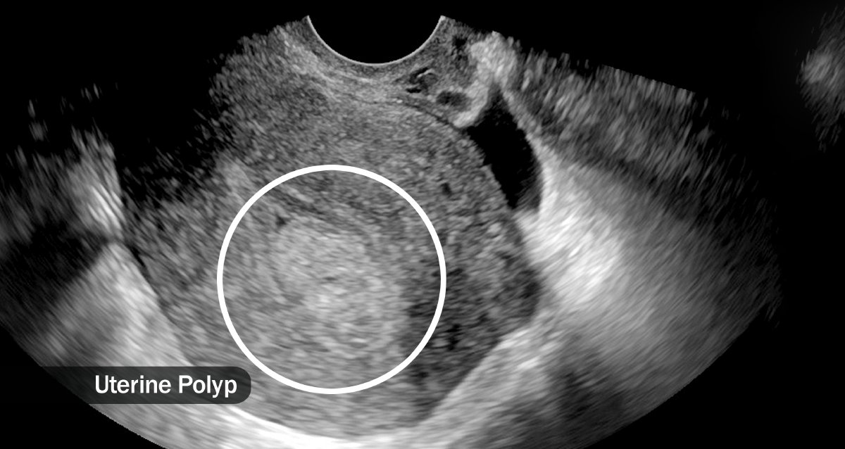 Uterine Polyps Ultrasound
